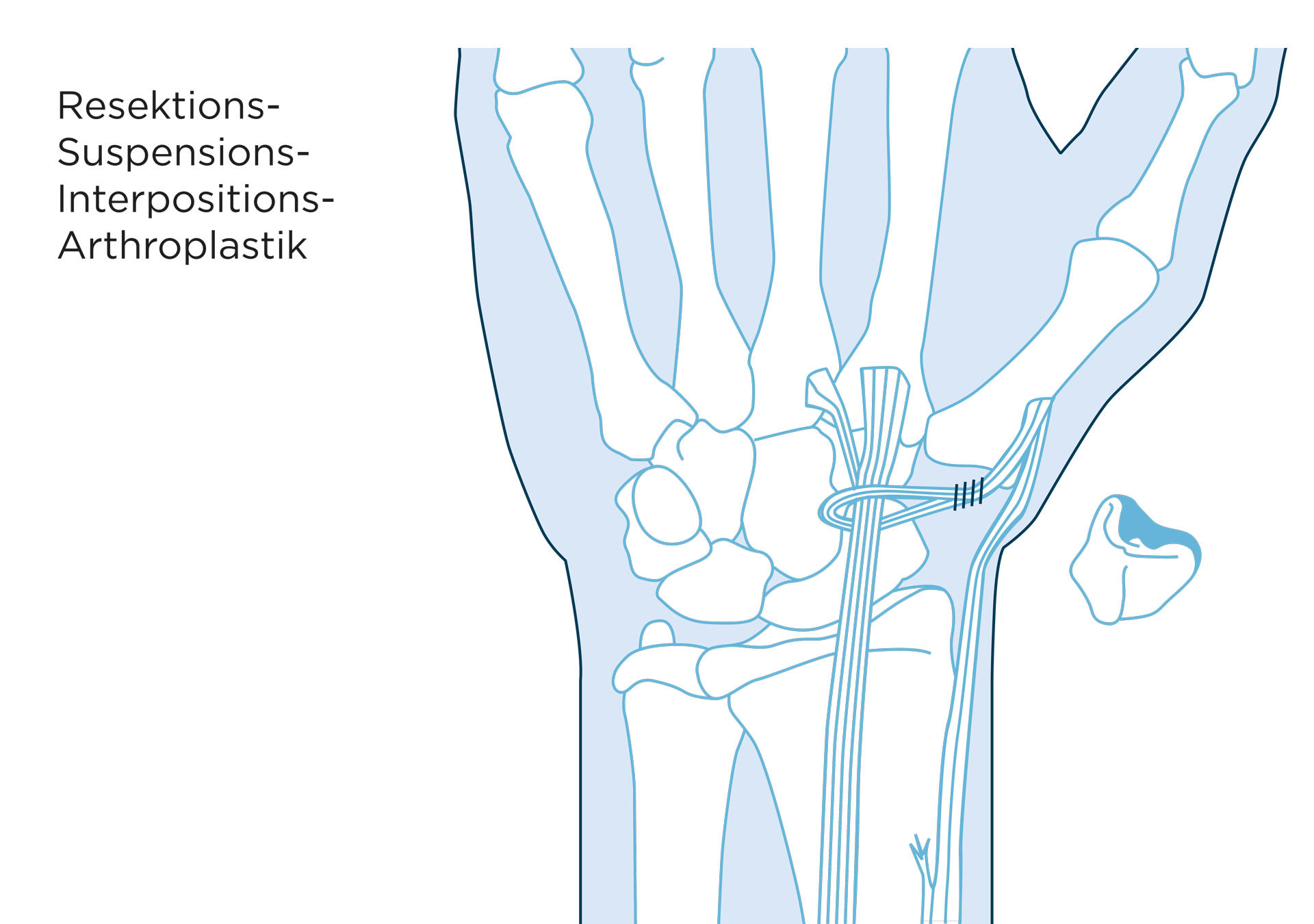 Daumensattelgelenksarthrose